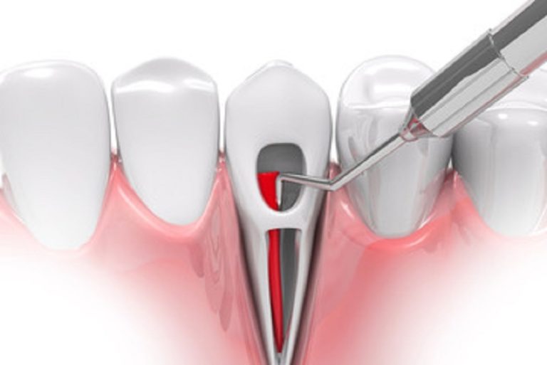 Root Canal Treatment Specialist in Robstown, TX | Root Canal Dentist